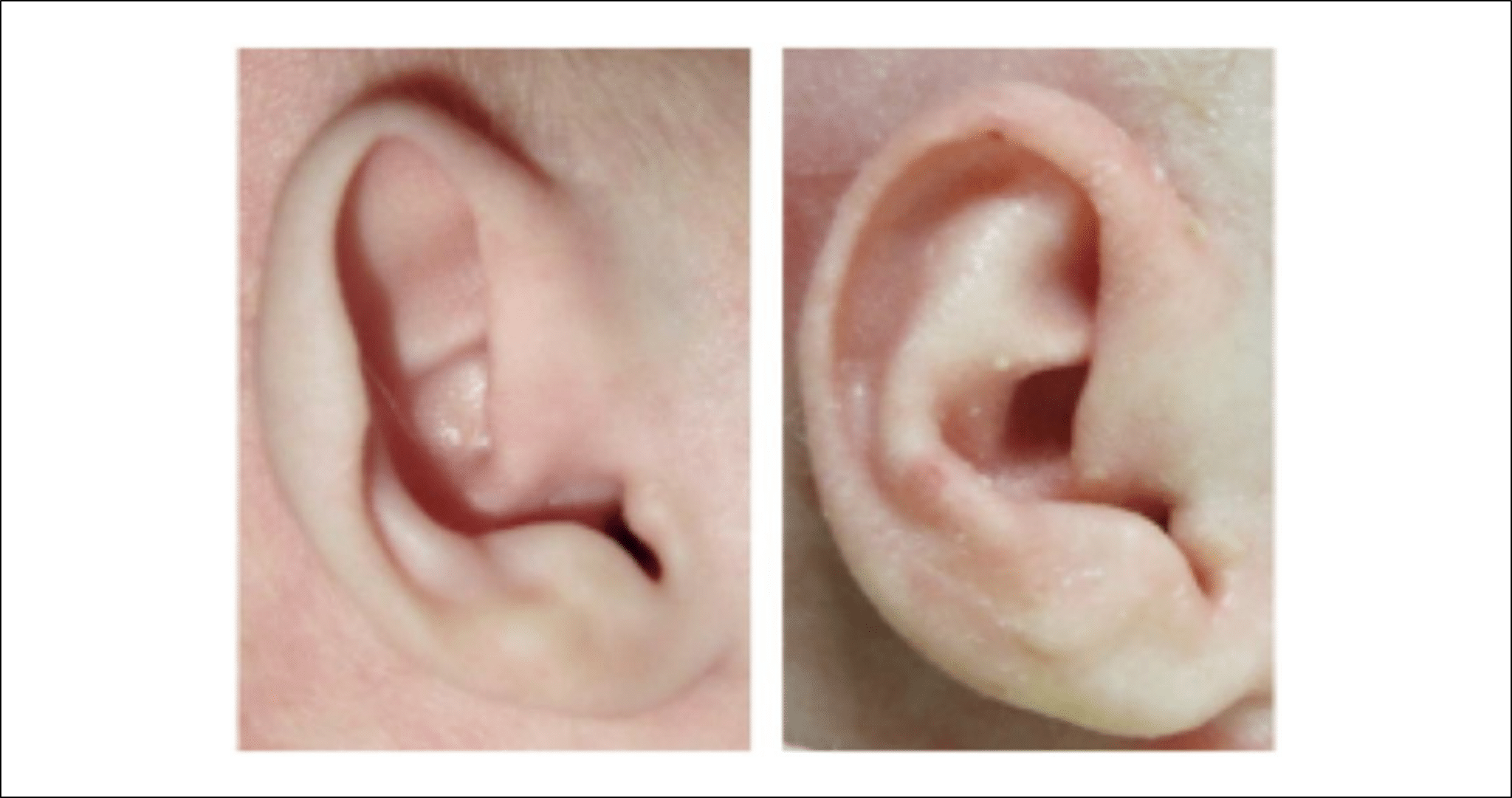 Deformations of the Ear and Their Nonsurgical Correction - Infant Ear
