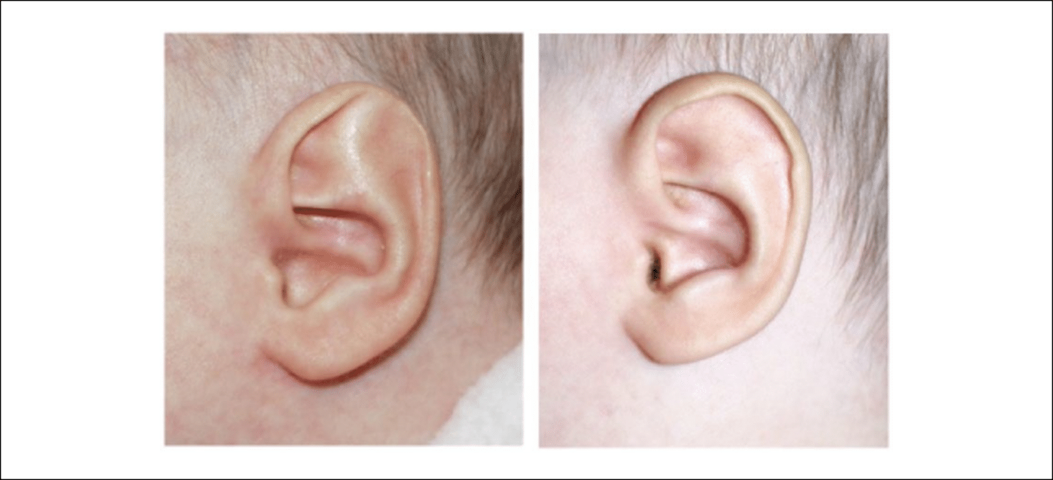 Deformations of the Ear and Their Nonsurgical Correction - Infant Ear