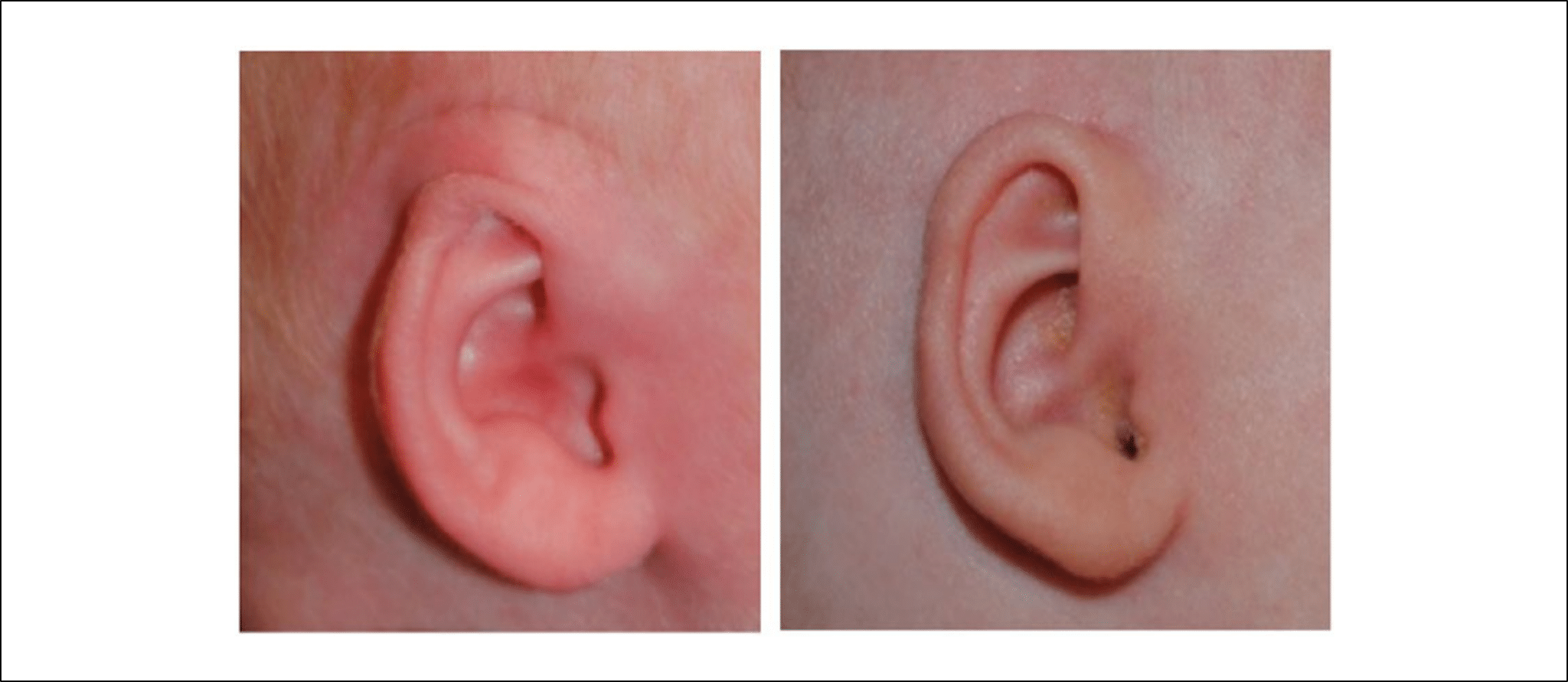 Deformations of the Ear and Their Nonsurgical Correction - Infant Ear