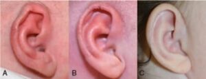 Public Perception of Helical Rim Deformities and Their Correction with ...