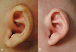 Public Perception of Helical Rim Deformities and Their Correction with ...
